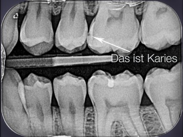 Warum Röntgenbilder machen, wenn man nach Karies sucht? Reicht es nicht ...